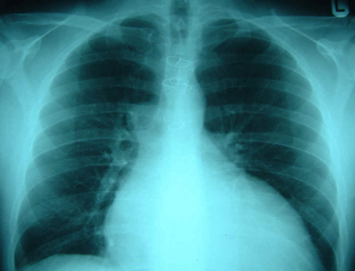 X-Rays – heart-transplant.co.uk